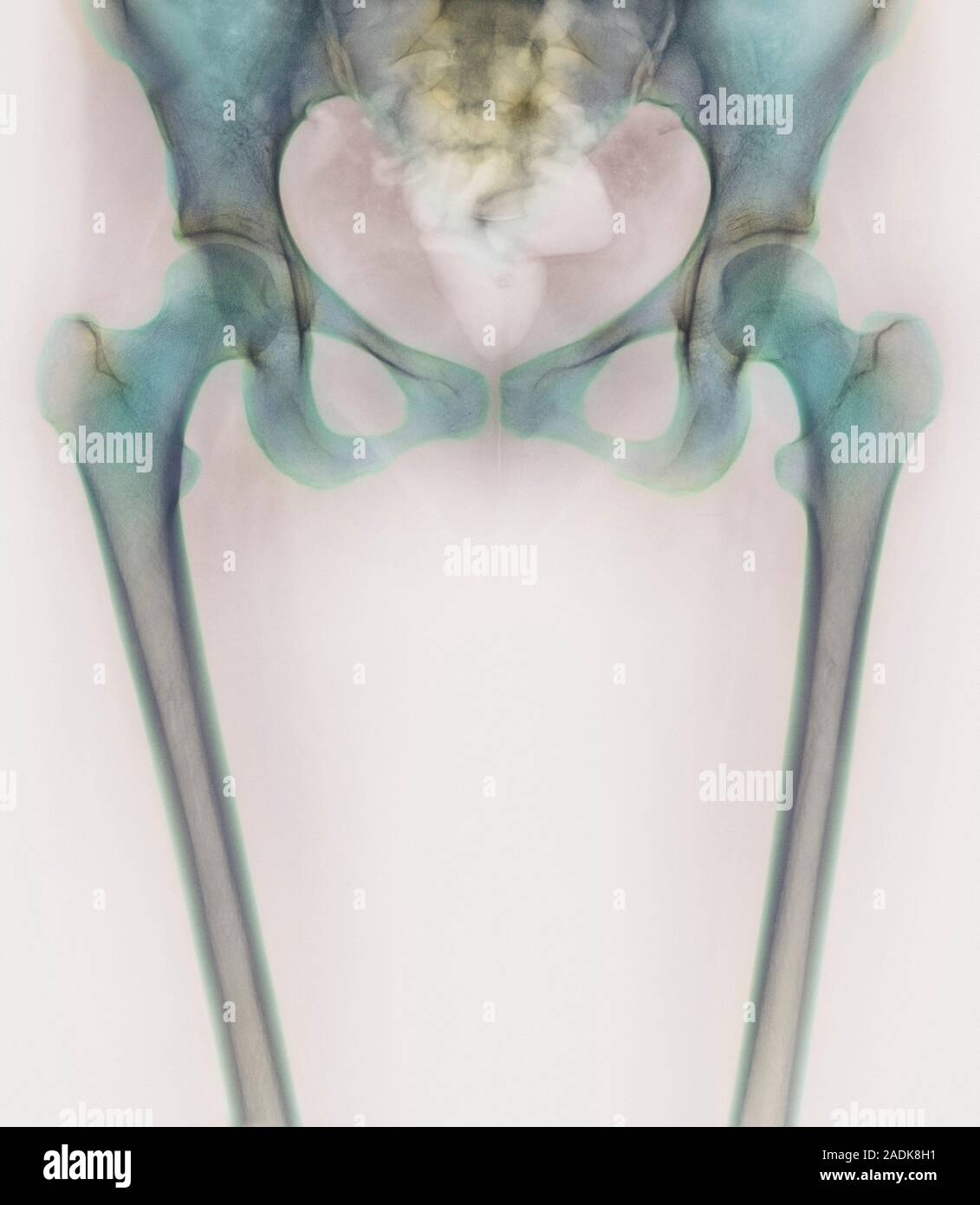 Hip joints. Coloured X-ray of a woman's groin and upper legs, revealing ...
