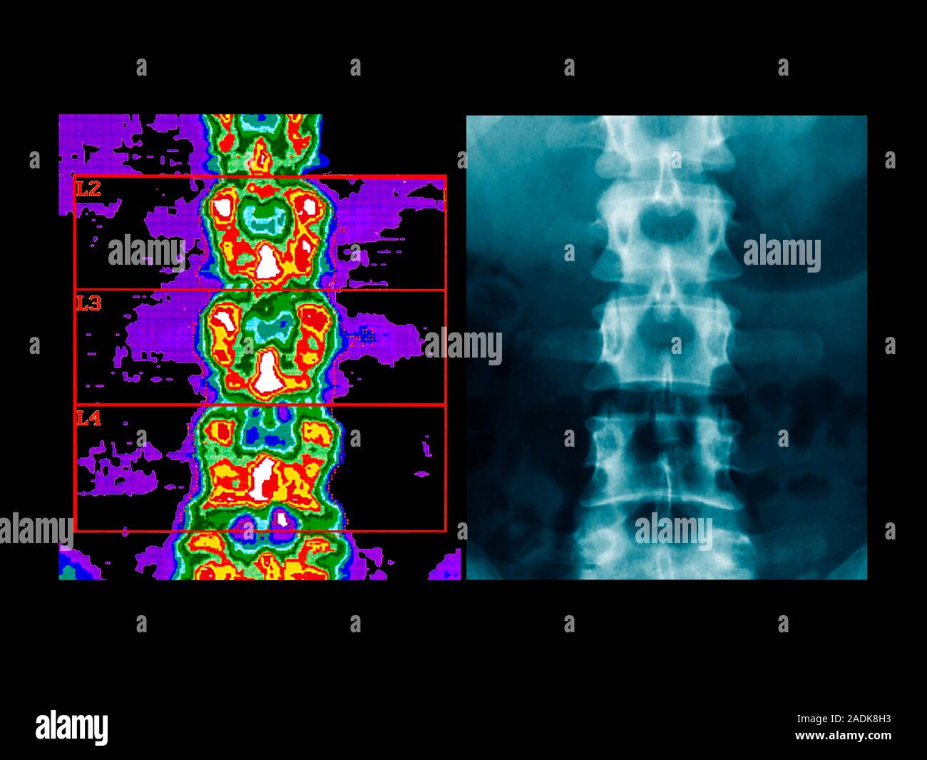 Spinal scan and X-ray. Coloured bone densitometry scan (left) and an X ...