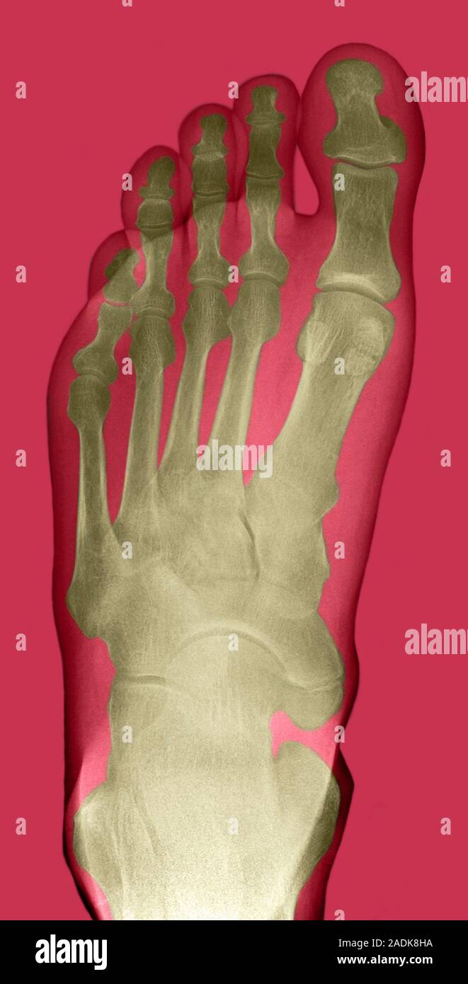 Normal foot. Coloured X-ray of a healthy human foot seen from the top ...