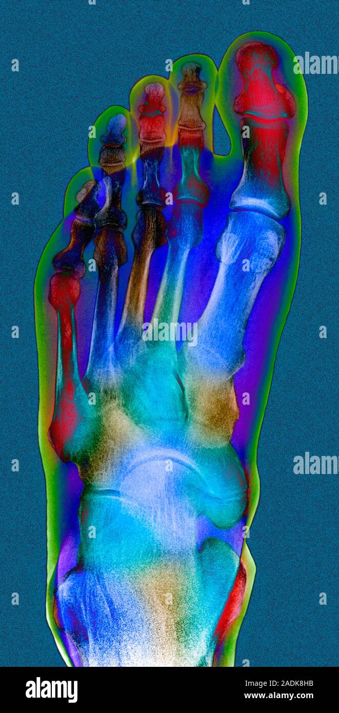 Normal foot. Coloured X-ray of a healthy human foot seen from the top ...