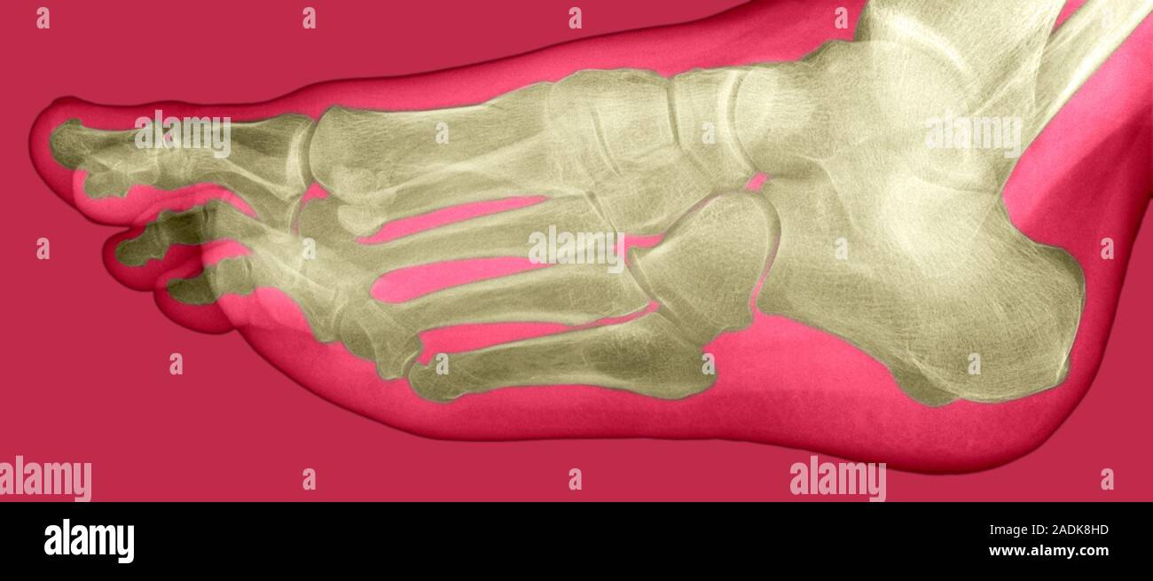 Normal foot. Coloured X-ray of a healthy human foot seen from the side ...