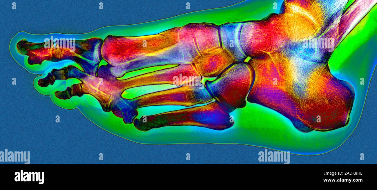 Normal foot. Coloured X-ray of a healthy human foot seen from the side ...
