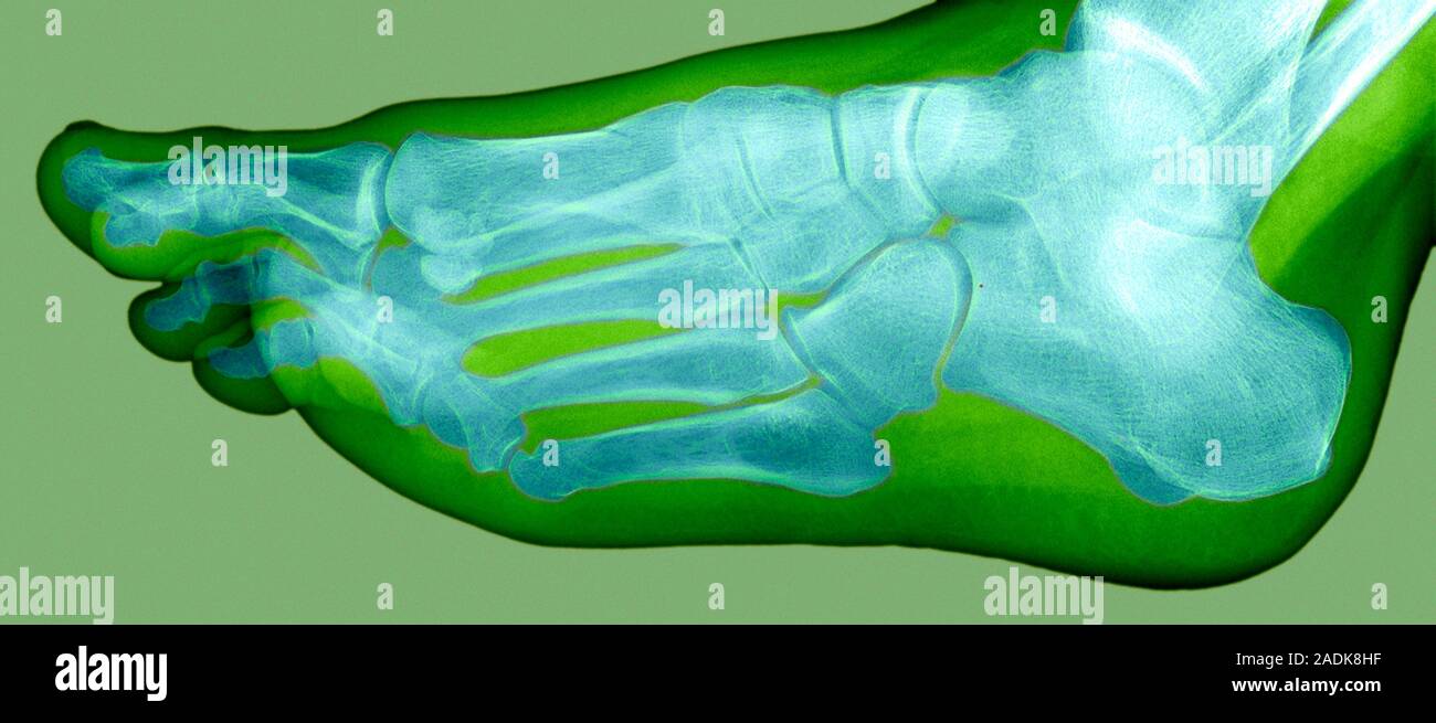 Normal foot. Coloured X-ray of a healthy human foot seen from the side ...