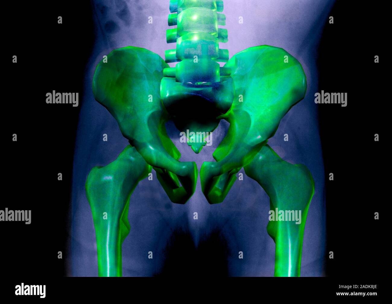 Pelvic x-ray. Composite image of a computer model of the pelvic bones ...