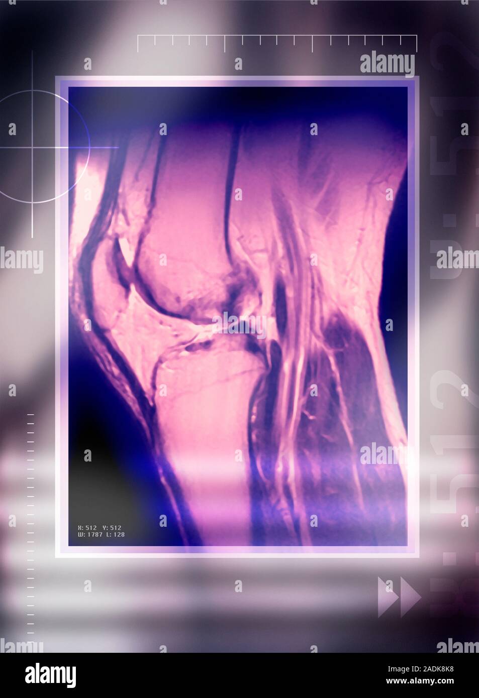 Knee joint, coloured magnetic resonance imaging (MRI) scan. In this ...