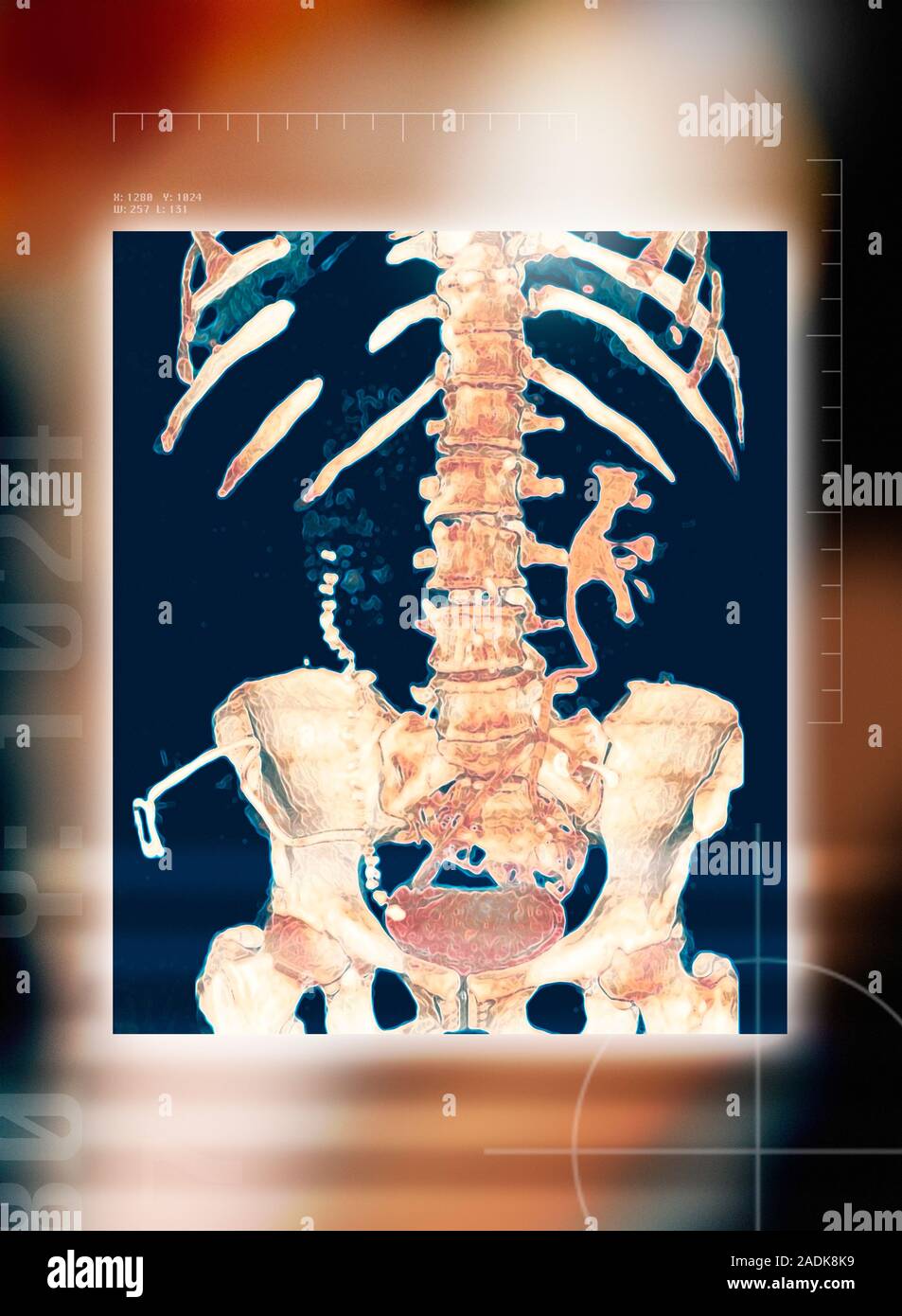 Abdominal bones, coloured 3-D computer tomography (CT) scan. The lower ...