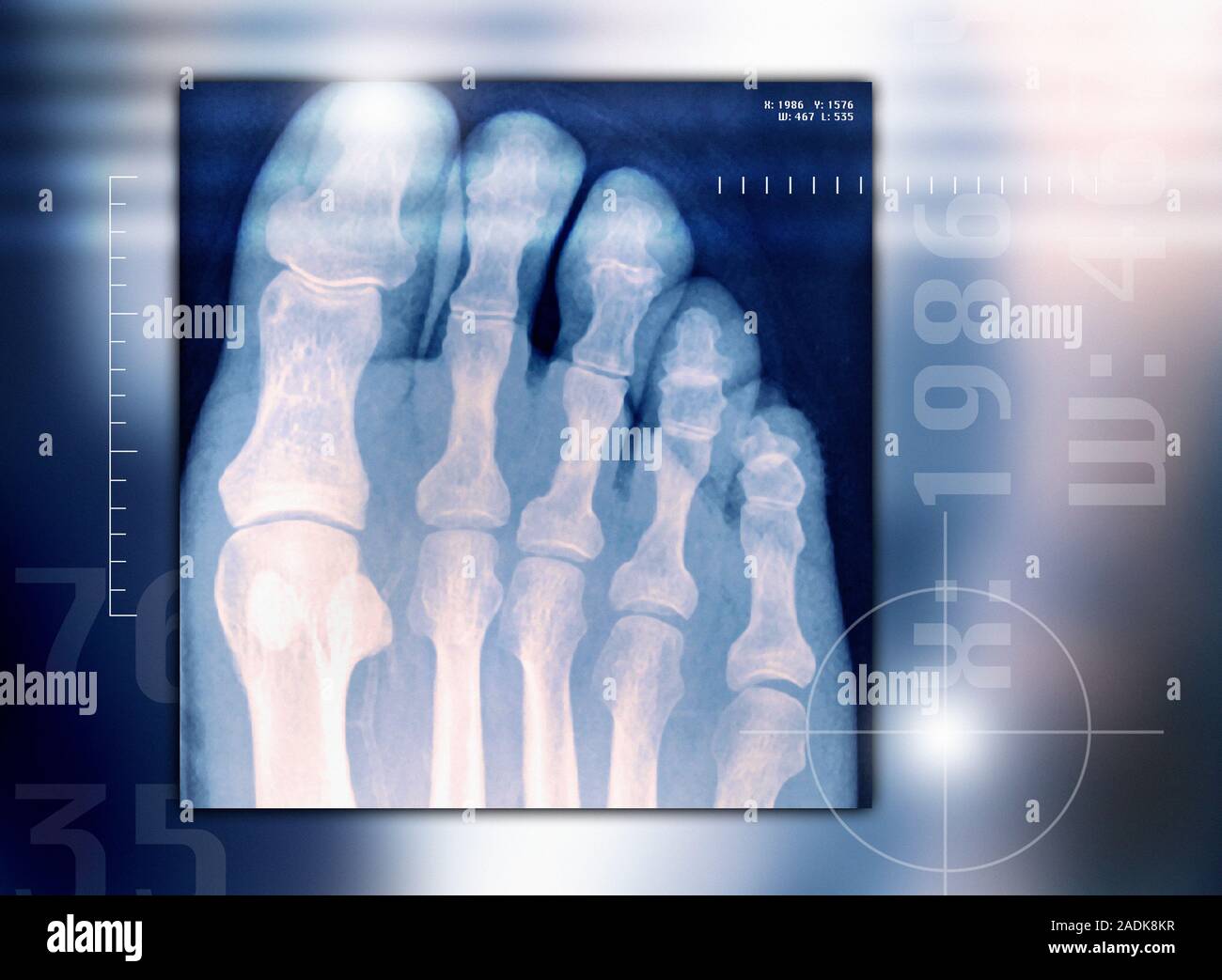 Toes, coloured X-ray. The toes are made up of phalanges bones, two for ...