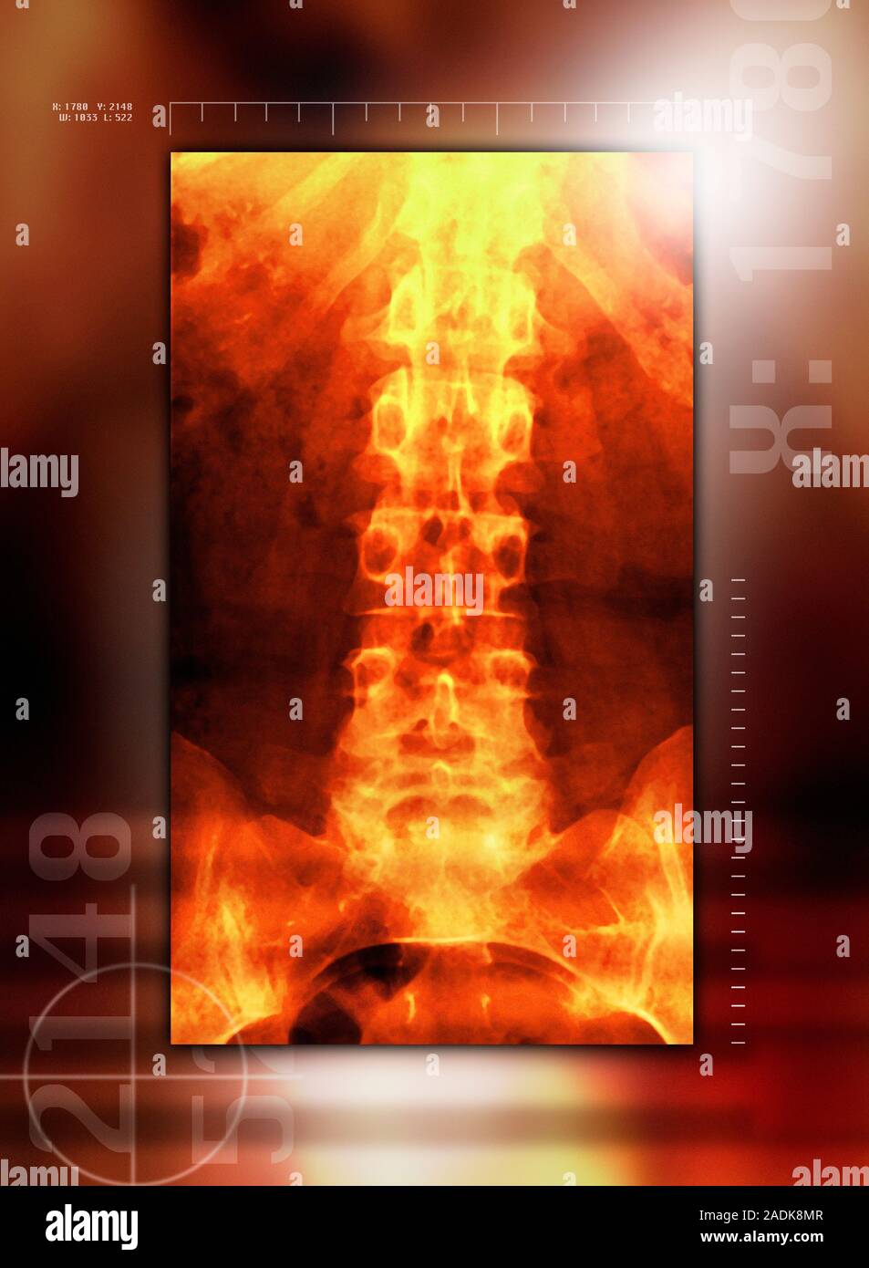 Healthy lower back, coloured X-ray. The spine runs down centre. It is ...