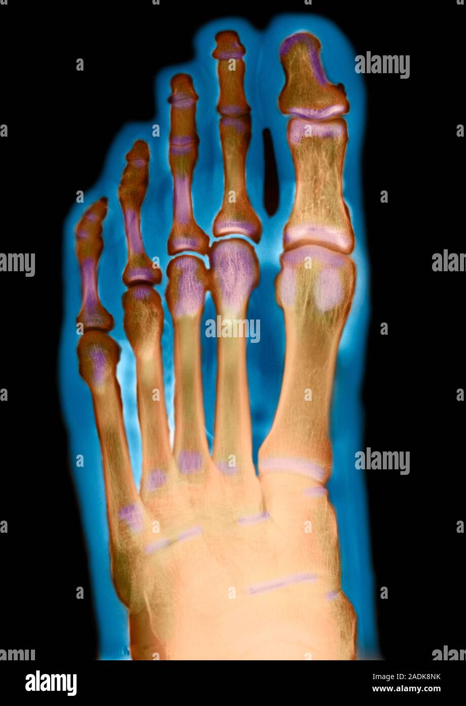 Foot. Coloured X-ray of the healthy foot of a 29 year old. The toes ...