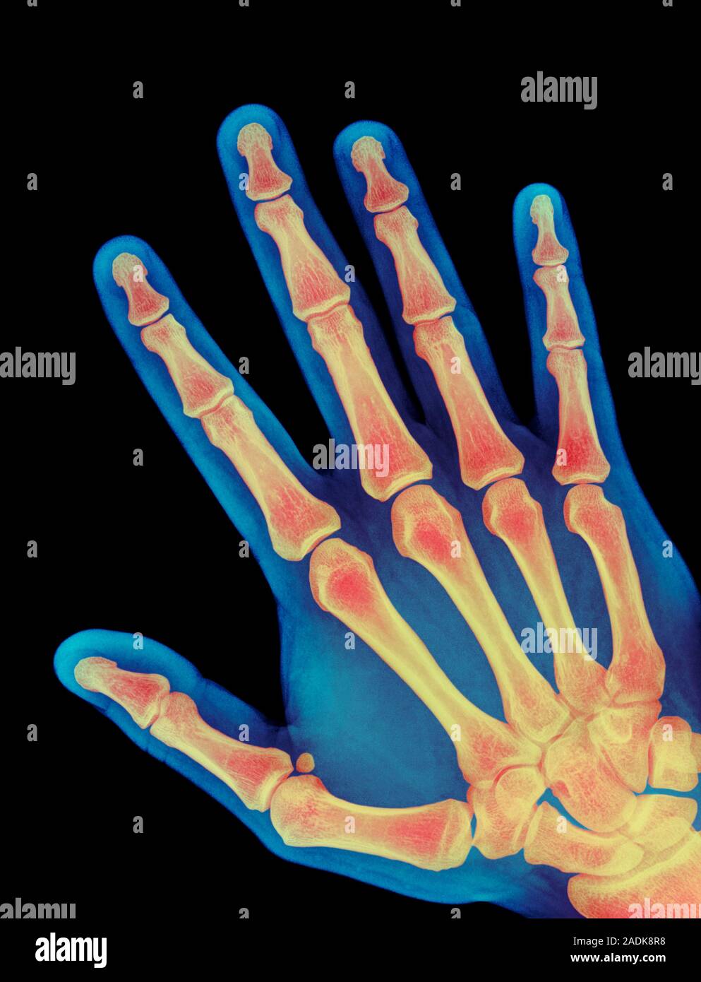 Healthy hand. Coloured X-ray of the healthy hand of a 60 year old man ...