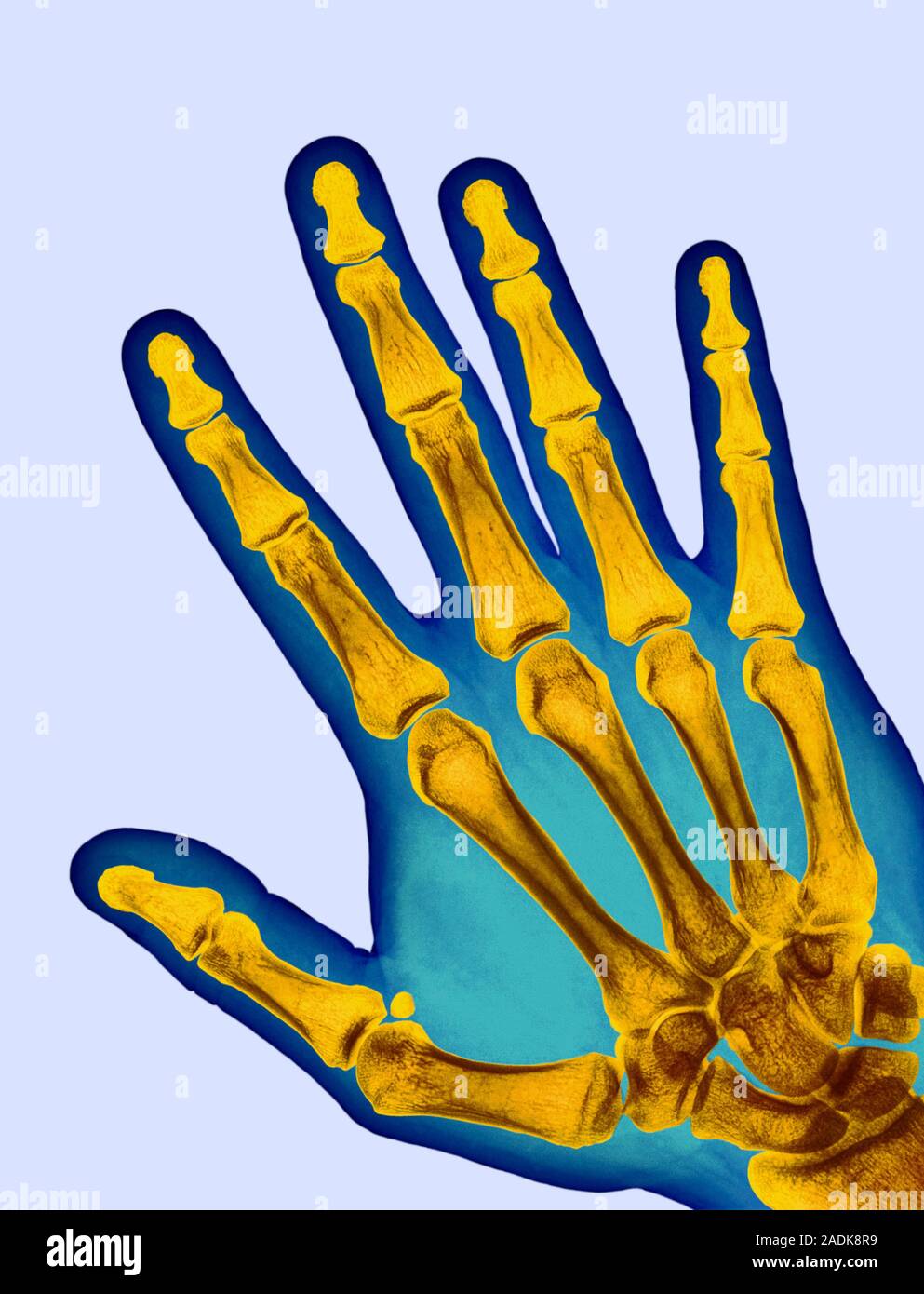 Healthy hand. Coloured X-ray of the healthy hand of a 60 year old man ...