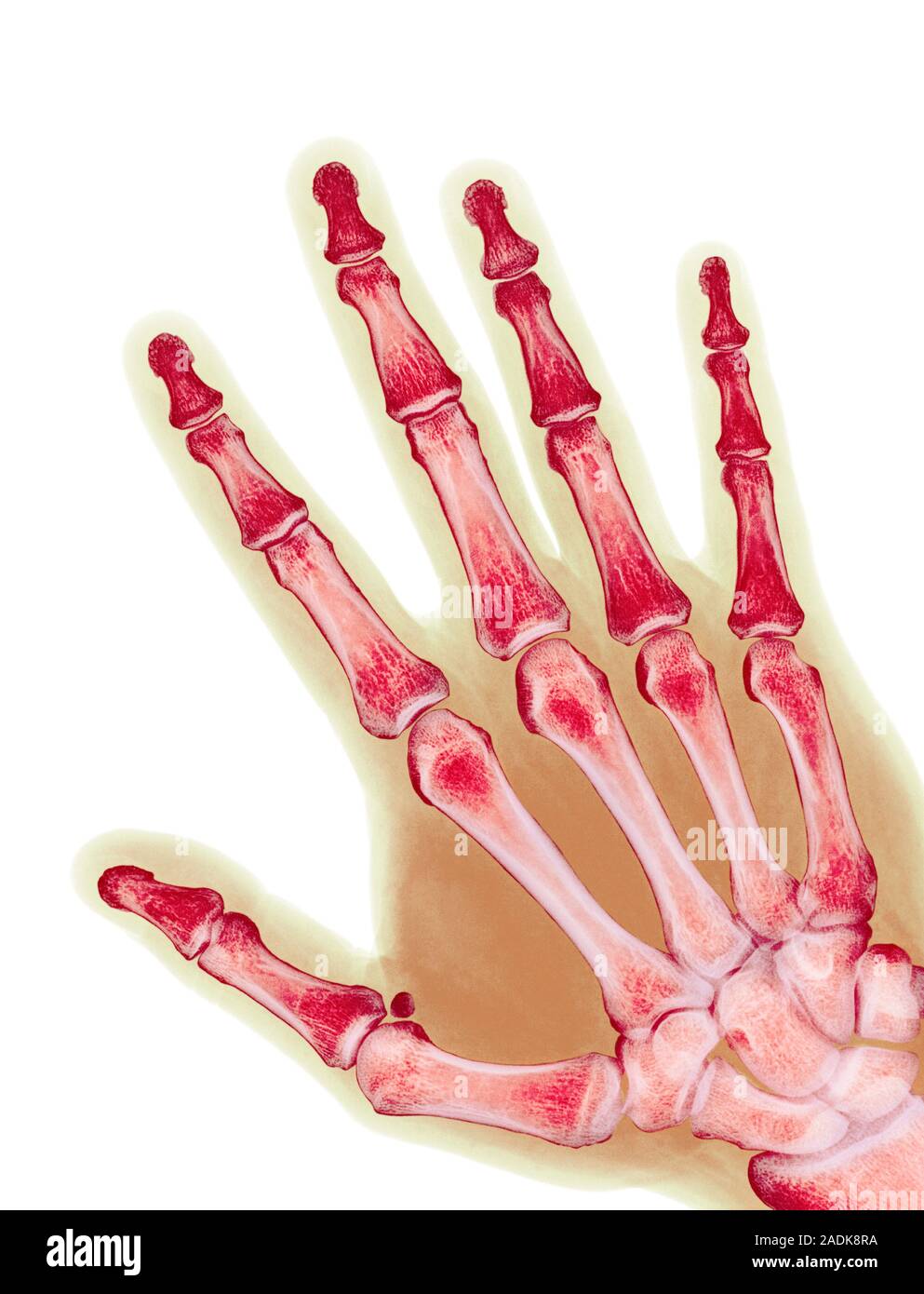 Healthy hand. Coloured X-ray of the healthy hand of a 60 year old man ...
