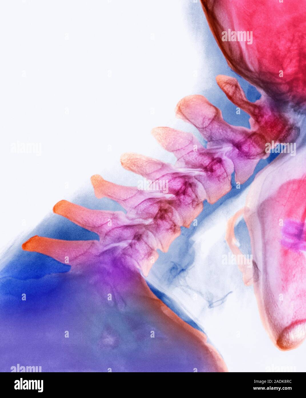 Bending of the neck. Coloured X-ray of a side view of the neck of a man ...