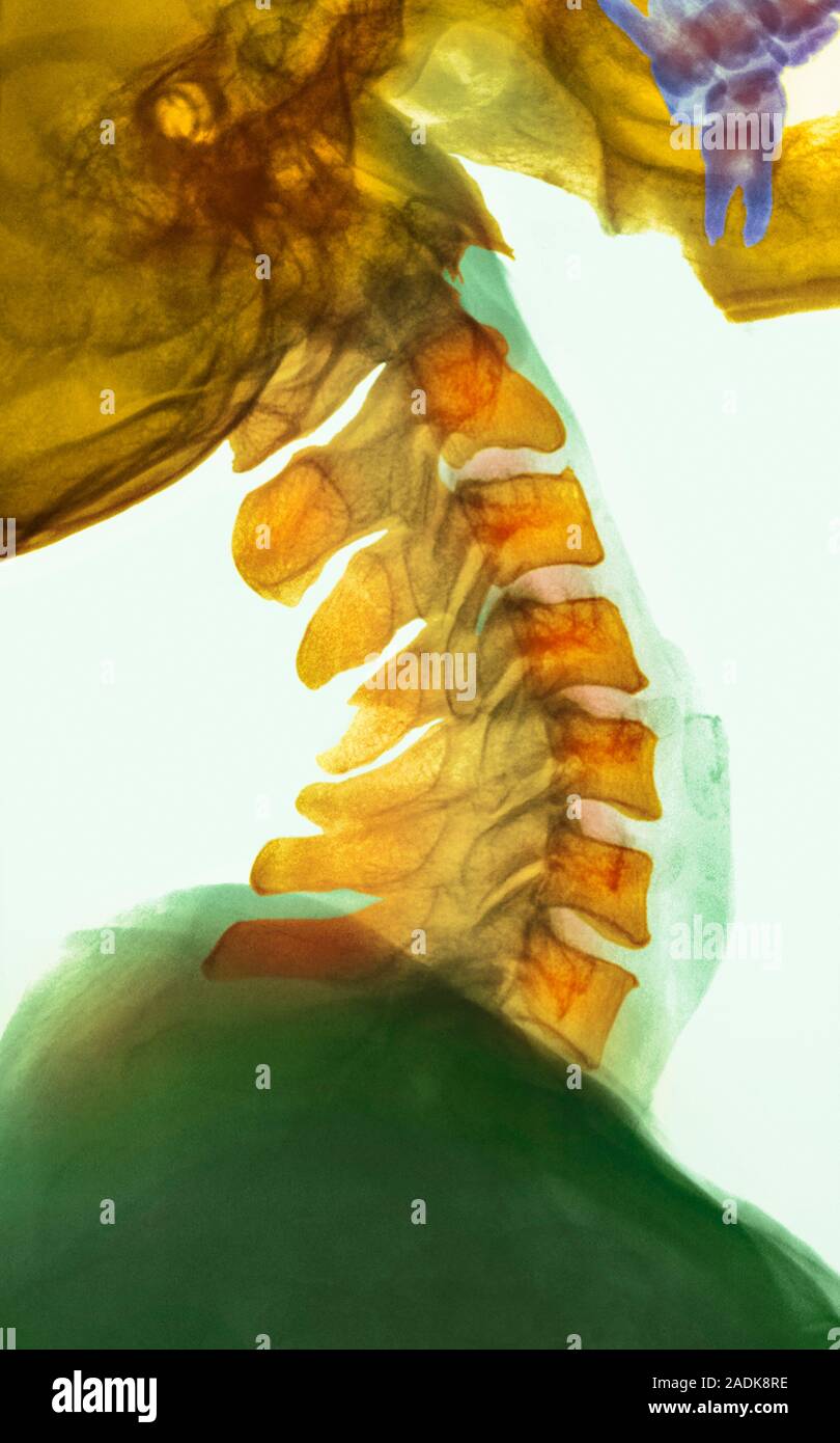 Bending of the neck. Coloured X-ray of a side view of the neck of a man ...