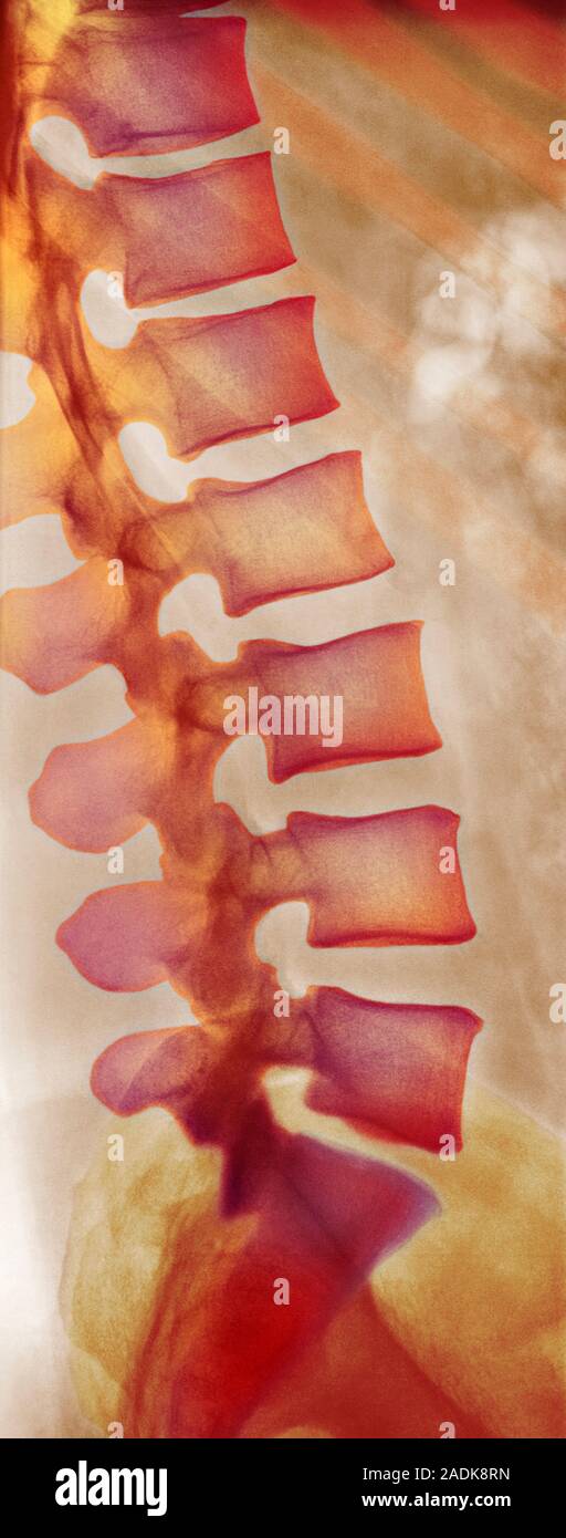 Healthy spine. Coloured X-ray of a side view of the healthy lower ...