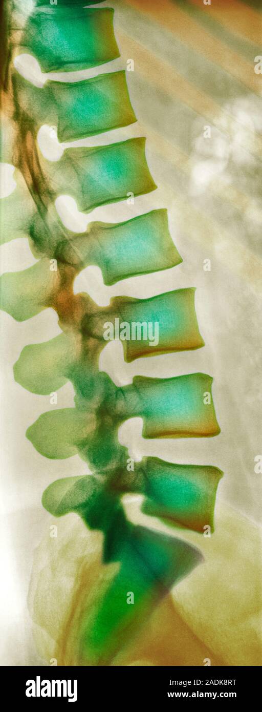 Healthy spine. Coloured X-ray of a side view of the healthy lower ...