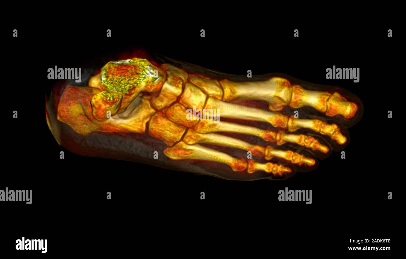 Foot, CT scan. Coloured 3-D computed tomography (CT) scan of the bones ...