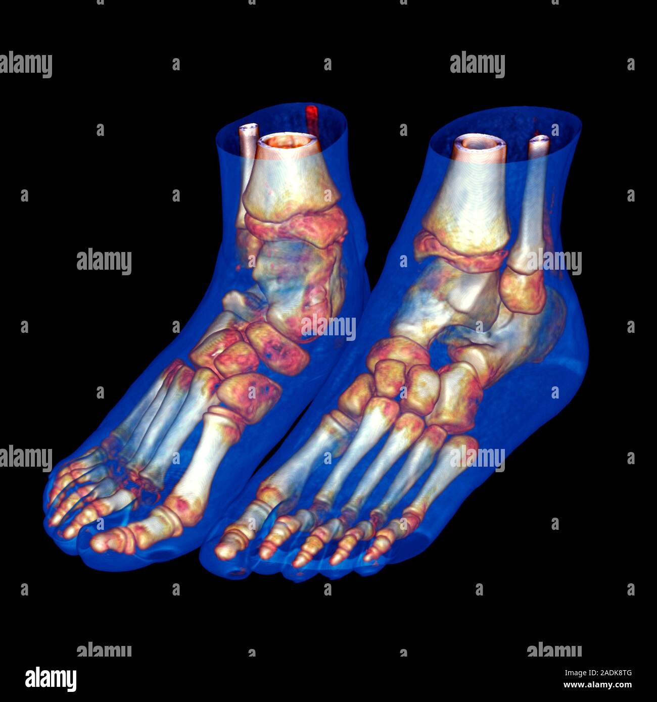 Feet, CT scan. Coloured three-dimensional computed tomography (CT) scan ...