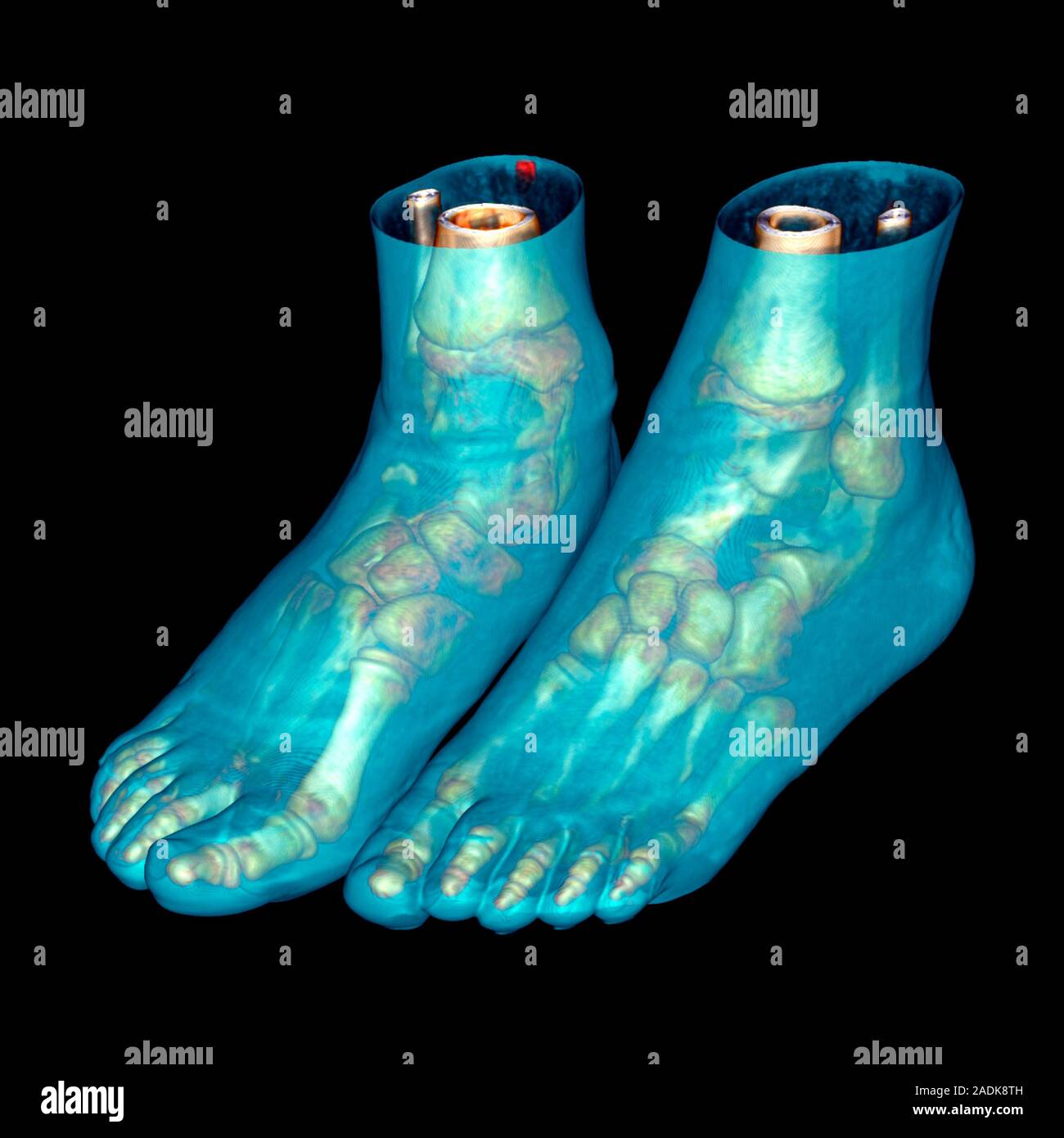Feet, CT scan. Coloured three-dimensional computed tomography (CT) scan ...