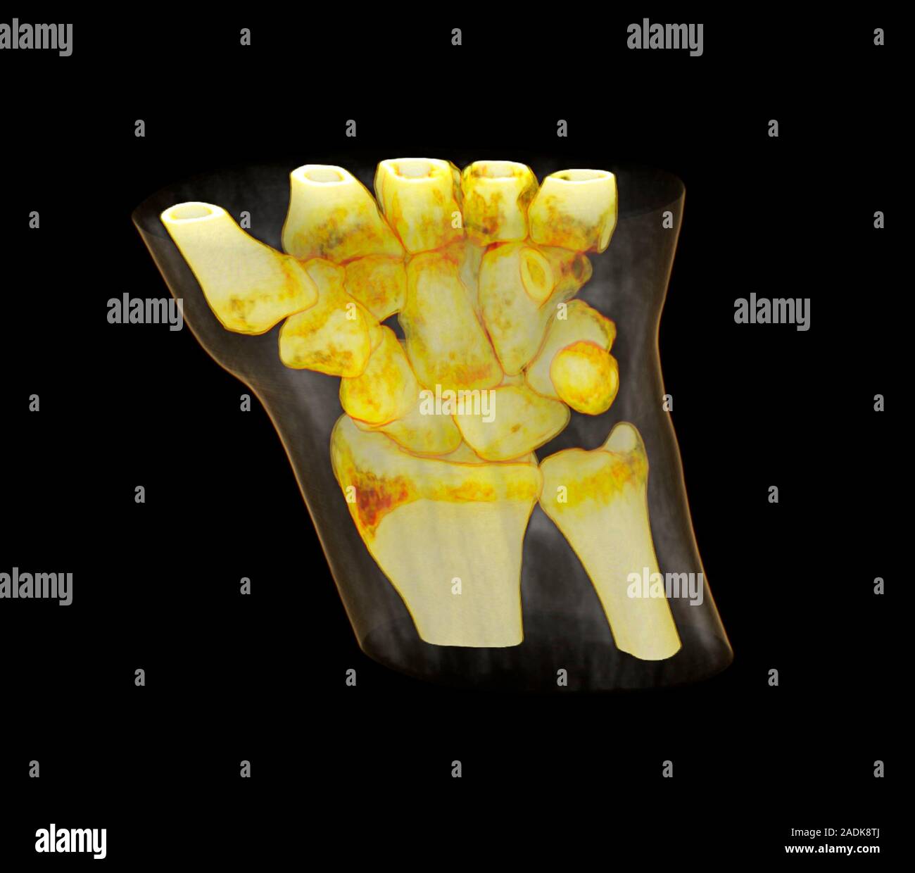 Wrist bones, CT scan. Coloured three-dimensional computed tomography ...