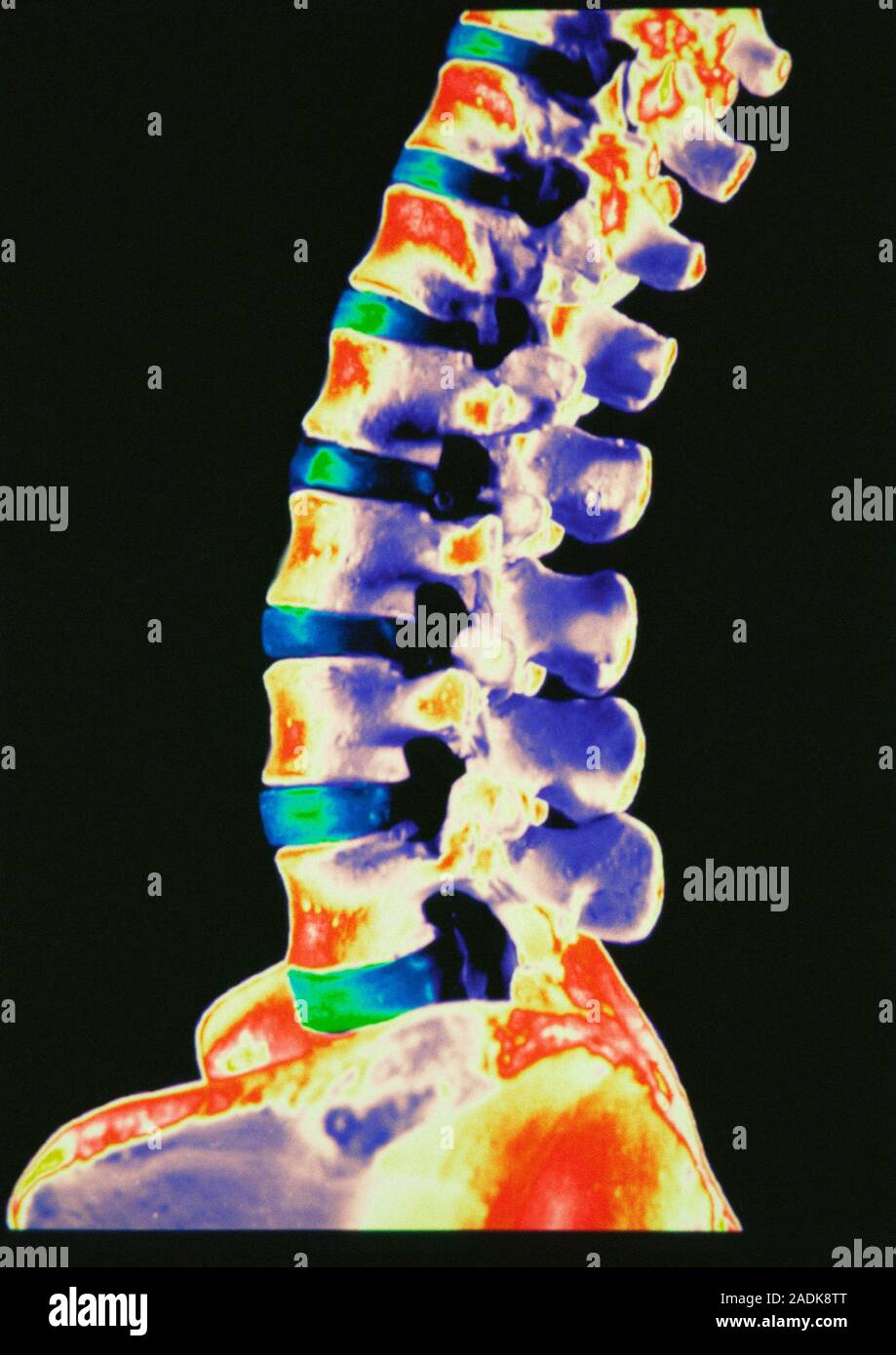 Spine. Coloured 3D magnetic resonance imaging (MRI) scan of a side-view ...