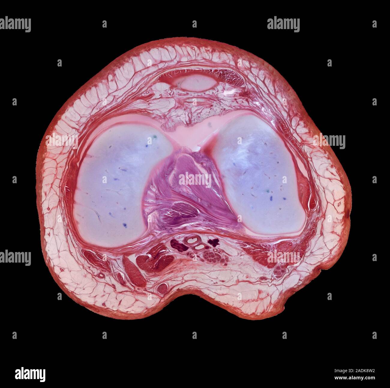 Knee joint. Macro photograph of a section through the knee joint of a ...