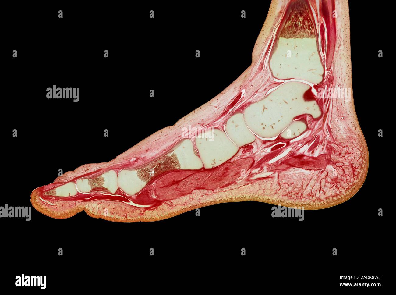 Foetal foot. Macro photograph of a sagittal section through the foot of ...