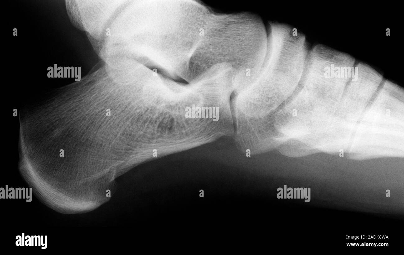 Ankle joint. X-ray of the lateral view of a normal ankle joint, or ...