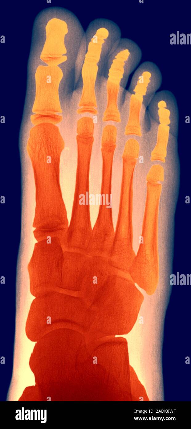 Child's foot. Coloured X-ray of the healthy right foot of an eight year ...