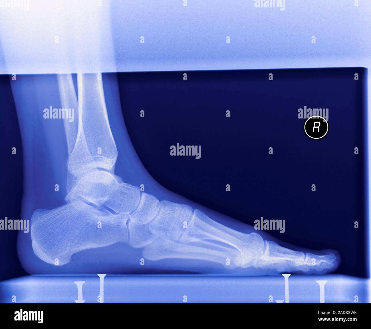 Foot. Coloured profile X-ray of the healthy right foot of a female ...