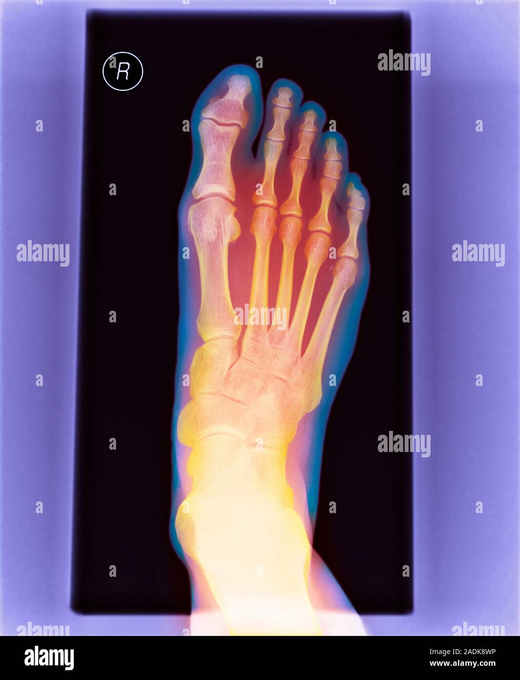 Foot, coloured X-ray. Top view of the healthy right foot of a female ...