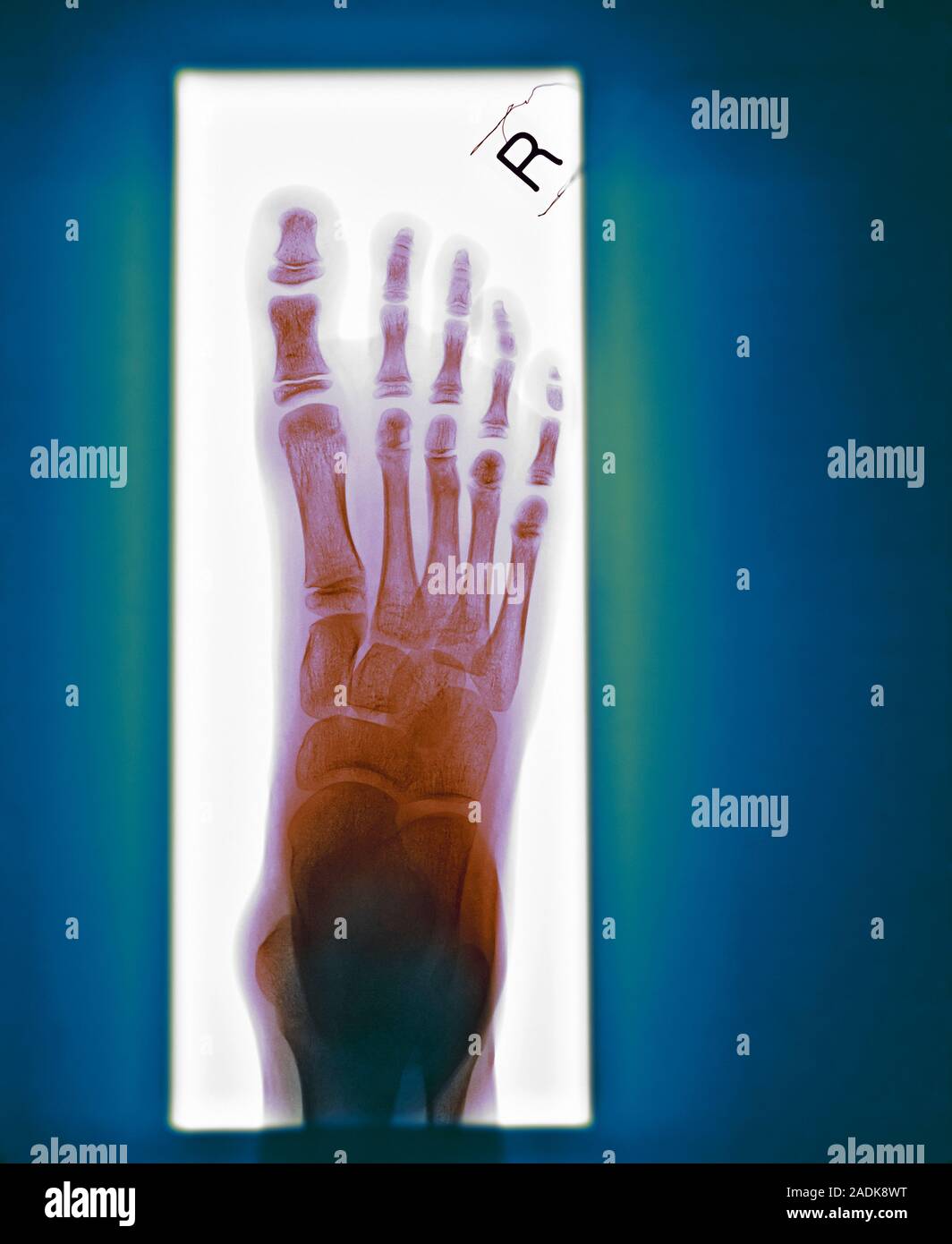 Foot, coloured X-ray. Top view of the healthy right foot of a male ...