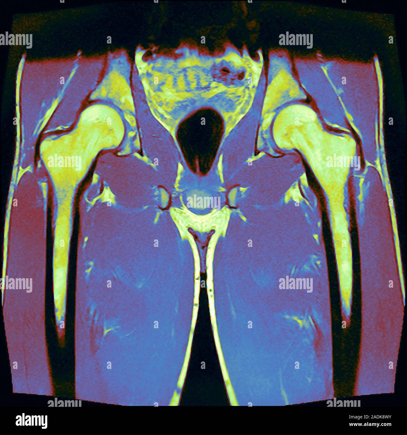 Healthy male hips. Coloured frontal magnetic resonance imaging (MRI ...