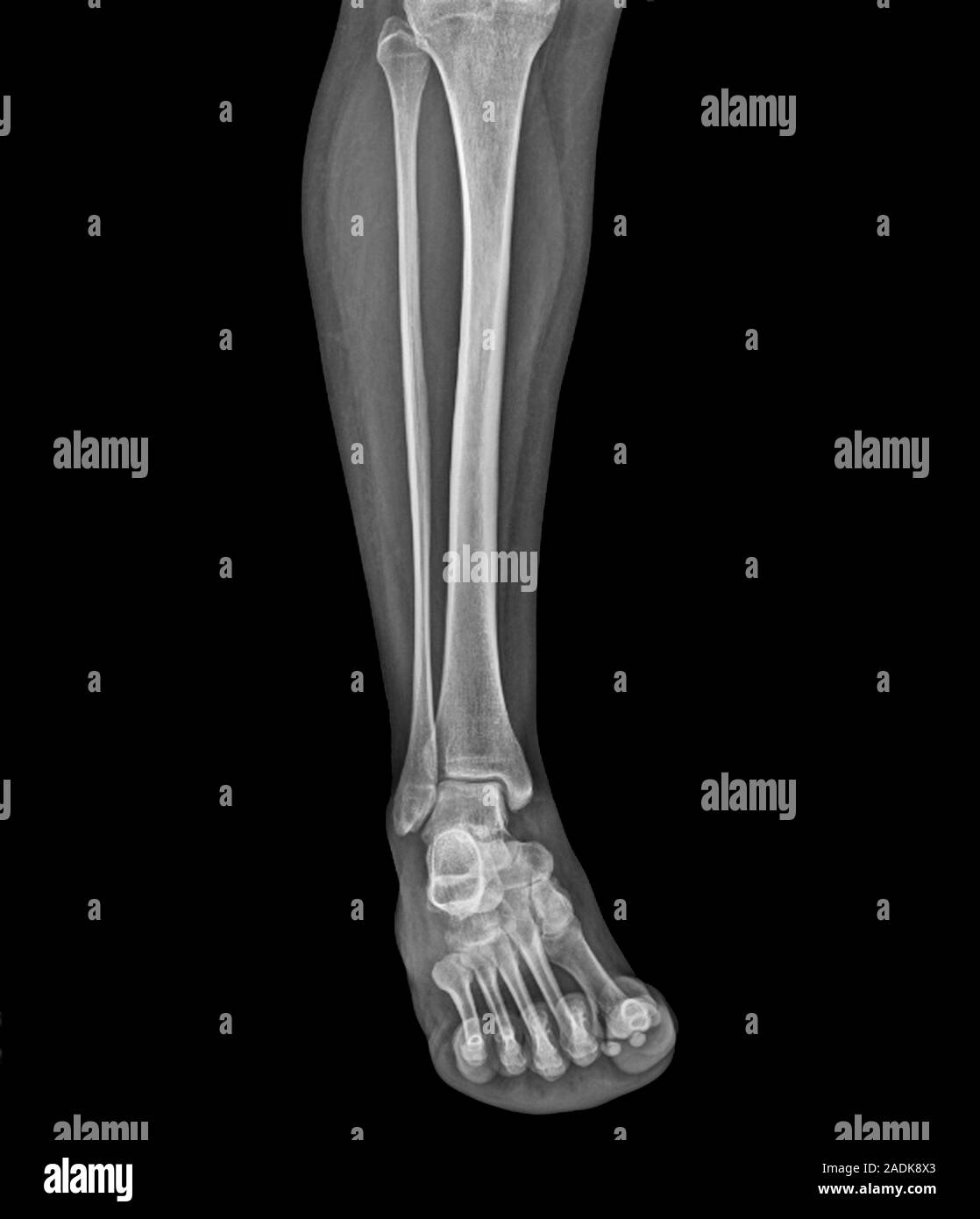Lower leg and foot. Frontal X-ray of the normal lower leg and foot of a ...
