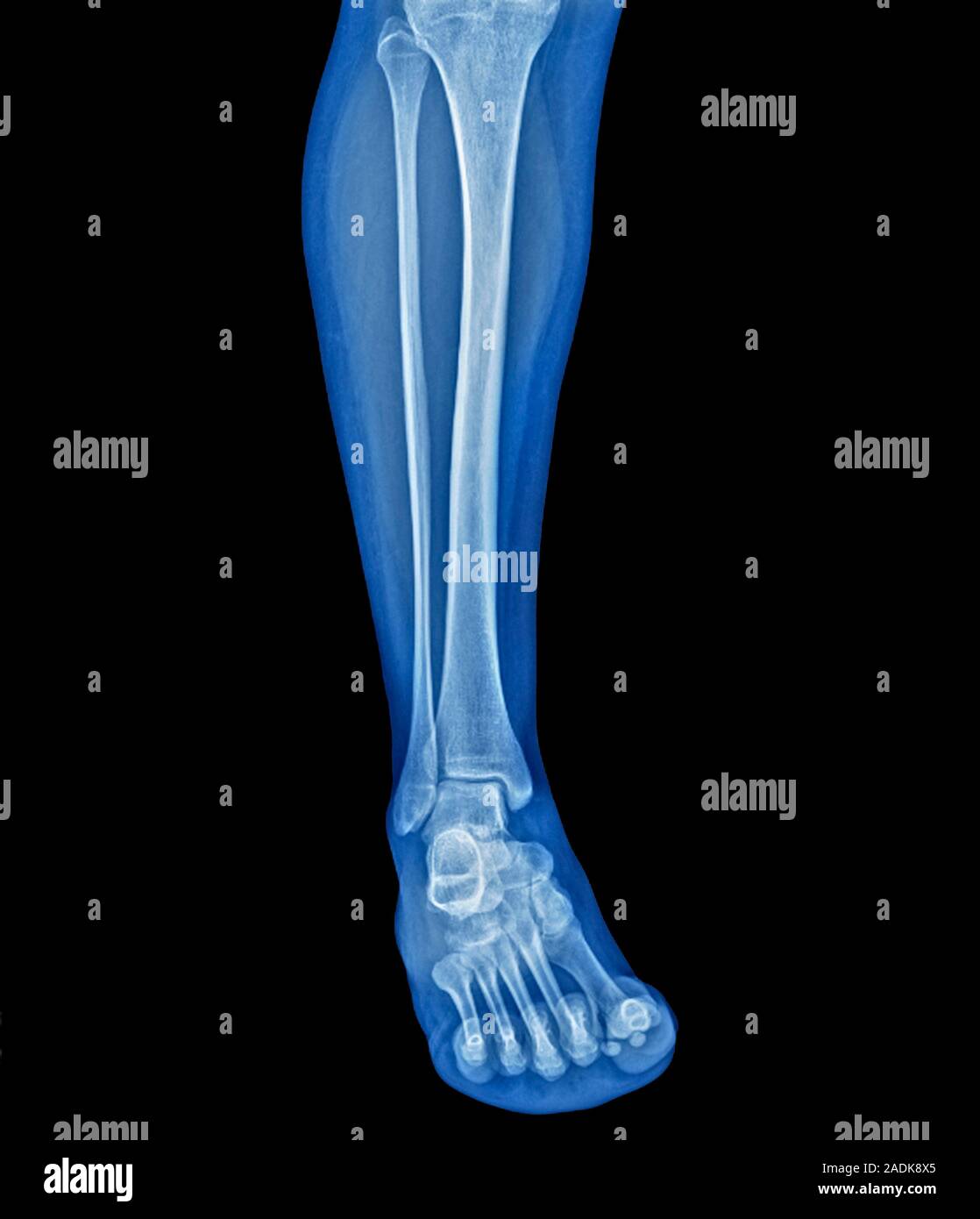 Lower leg and foot. Coloured frontal X-ray of the normal lower leg and ...