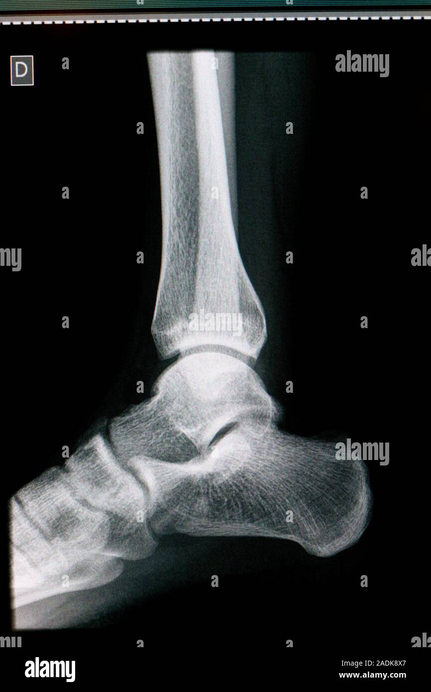 Ankle joint. X-ray of the profile view of a normal right ankle ...