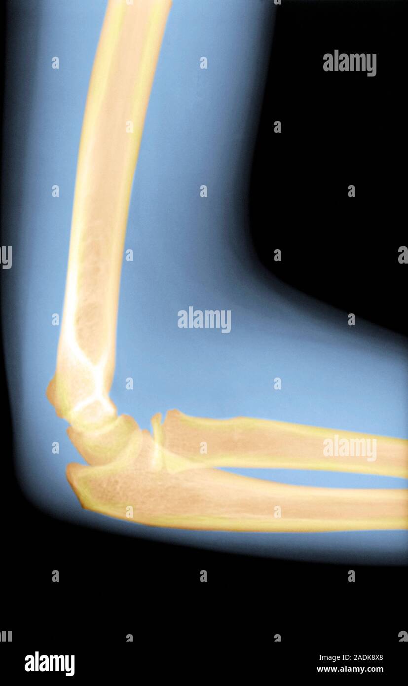 Coloured lateral X-ray showing a normal 12 year old child's elbow. The ...