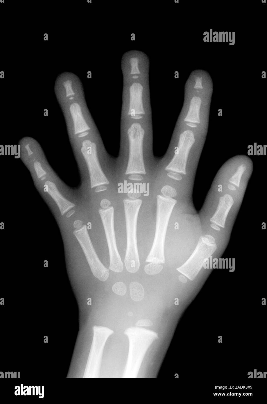 Child's hand. X-ray showing the bones in the hand of a normal three ...