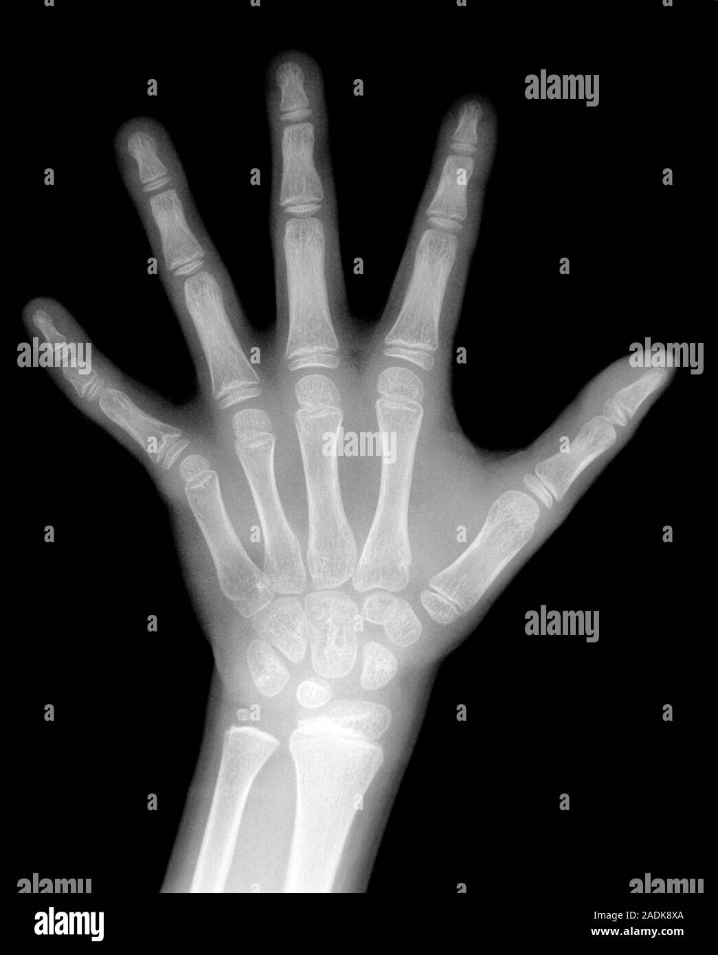 Child's hand. X-ray showing the normal configuration of bones in the ...