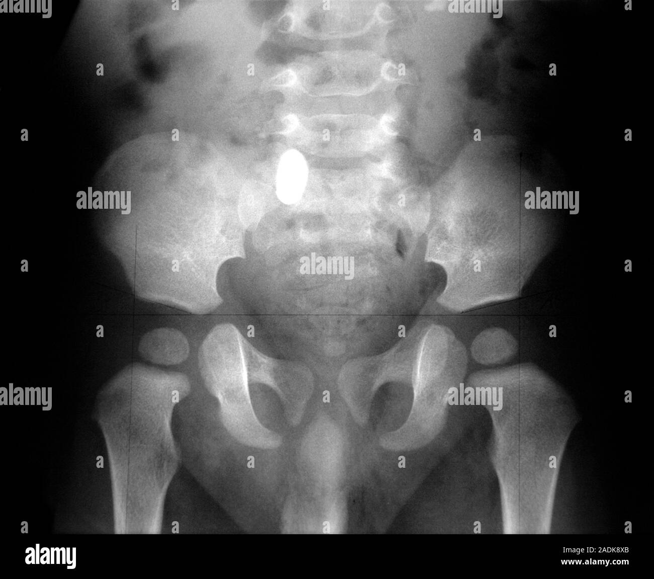 Normal hip x-ray of a young child. Frontal X-ray of the hip joints of a ...