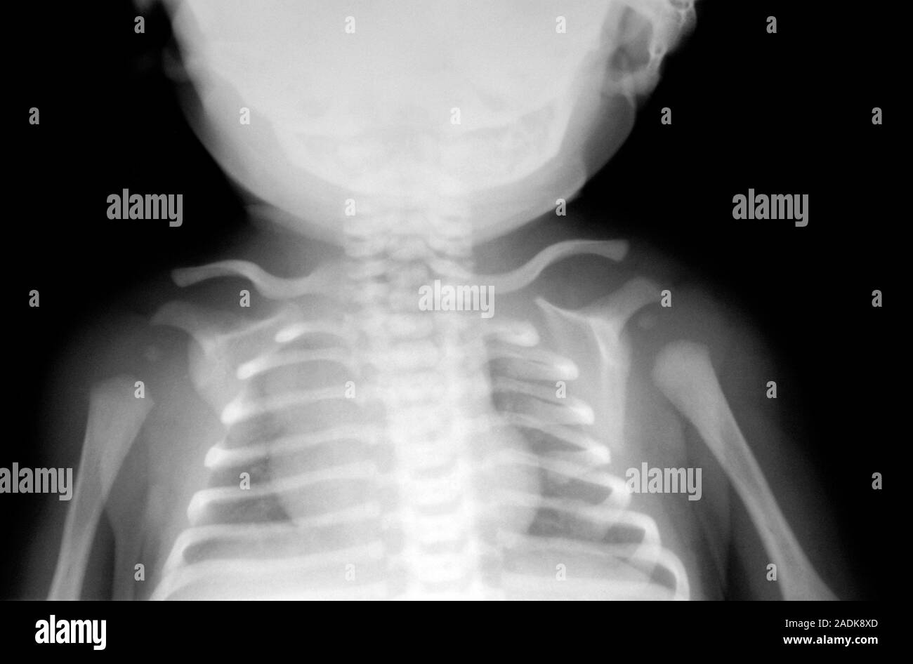 X-ray of a young child. X-ray of the normal upper chest and shoulders ...