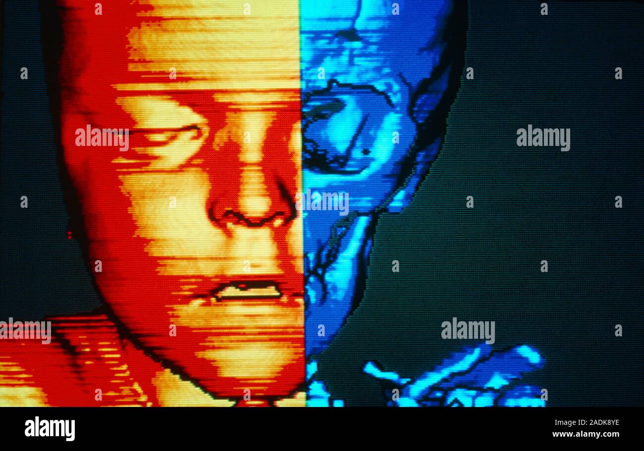 3-D reconstruction of a child's head using CT (computed tomography ...