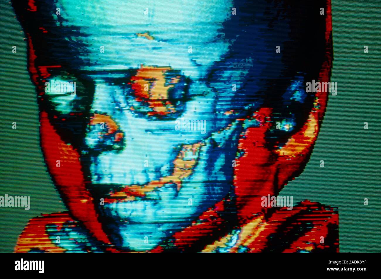 3-D reconstruction of a child's head using CT (computed tomography ...