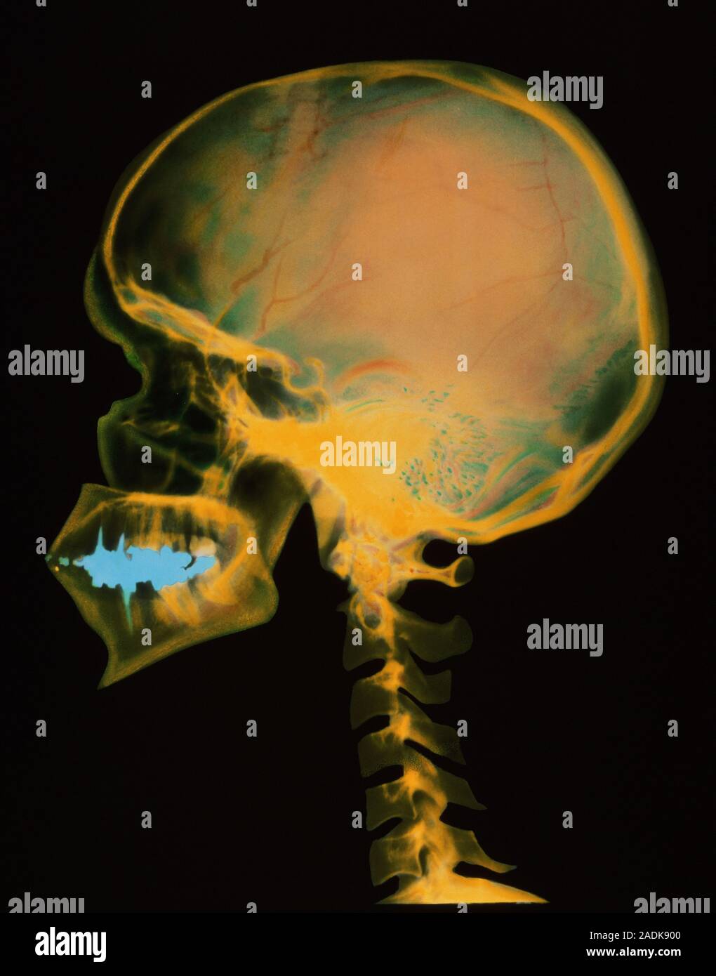 Human skull. Coloured X-ray of a healthy human skull and neck, seen in ...