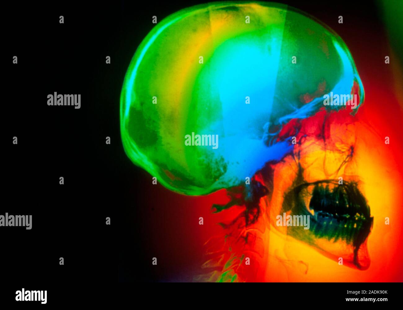 Skull. Coloured X-ray of a human skull, in side view. The face is at ...