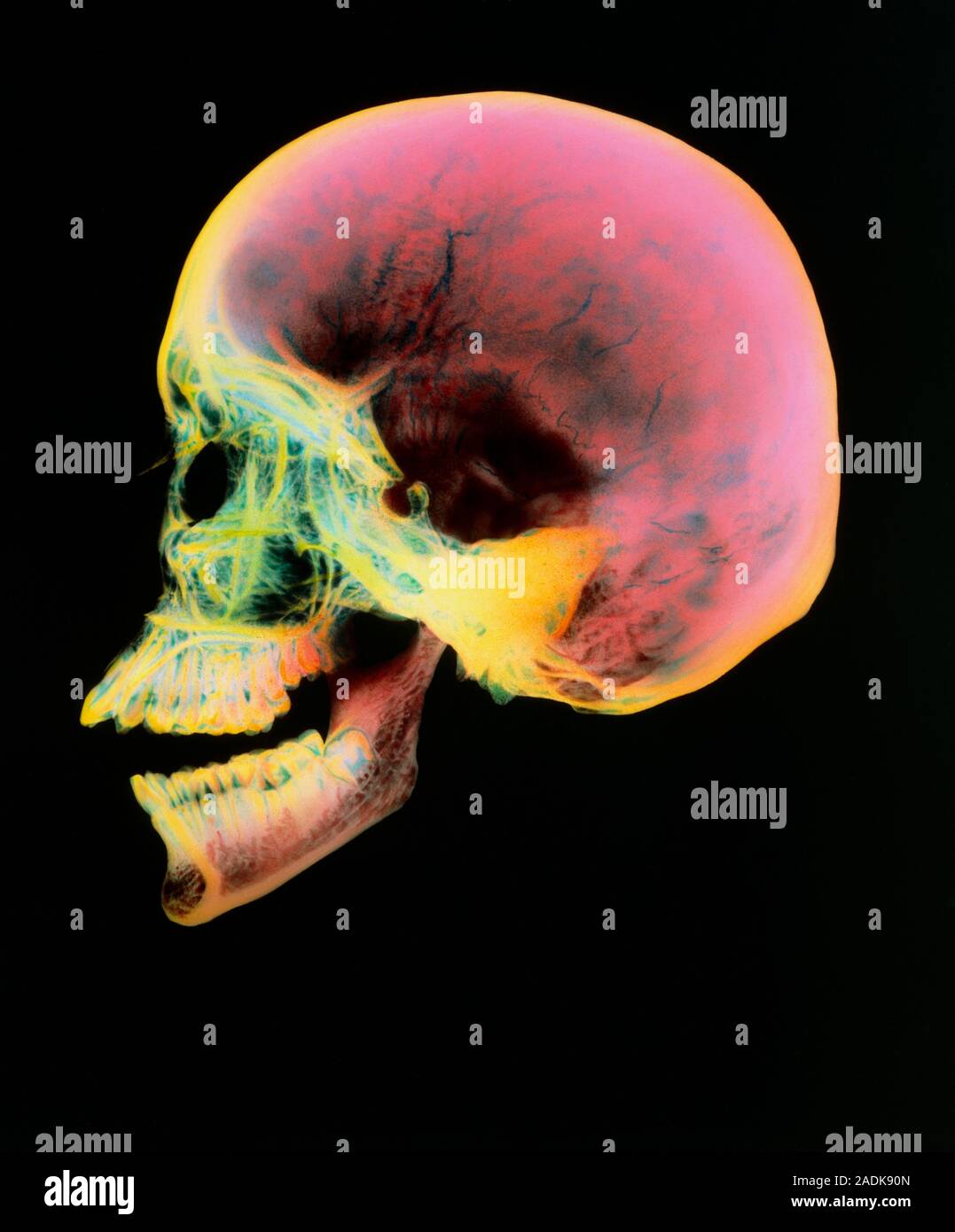 Skull. Coloured X-ray of a human skull seen from the side. The face is ...