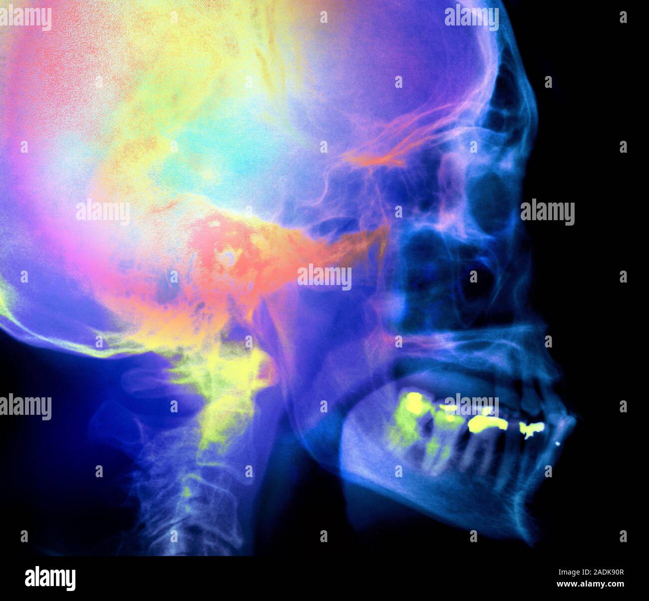 Skull. Coloured X-ray of a human skull seen from the side. The face is ...