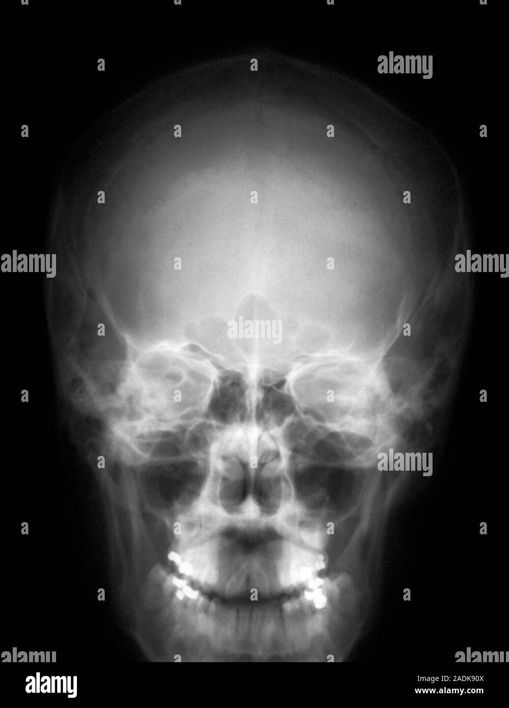 Human skull. X-ray of a human skull, seen from the front. At top is the ...
