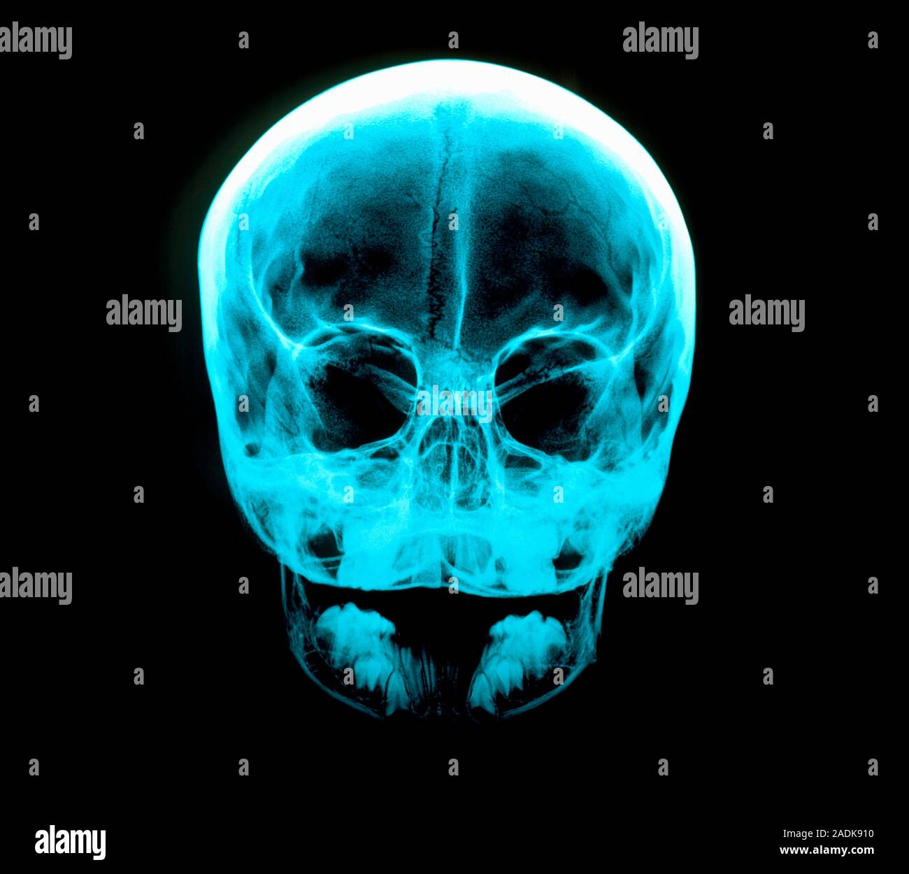 Human skull. X-ray of a human skull, seen from the front. At top is the ...