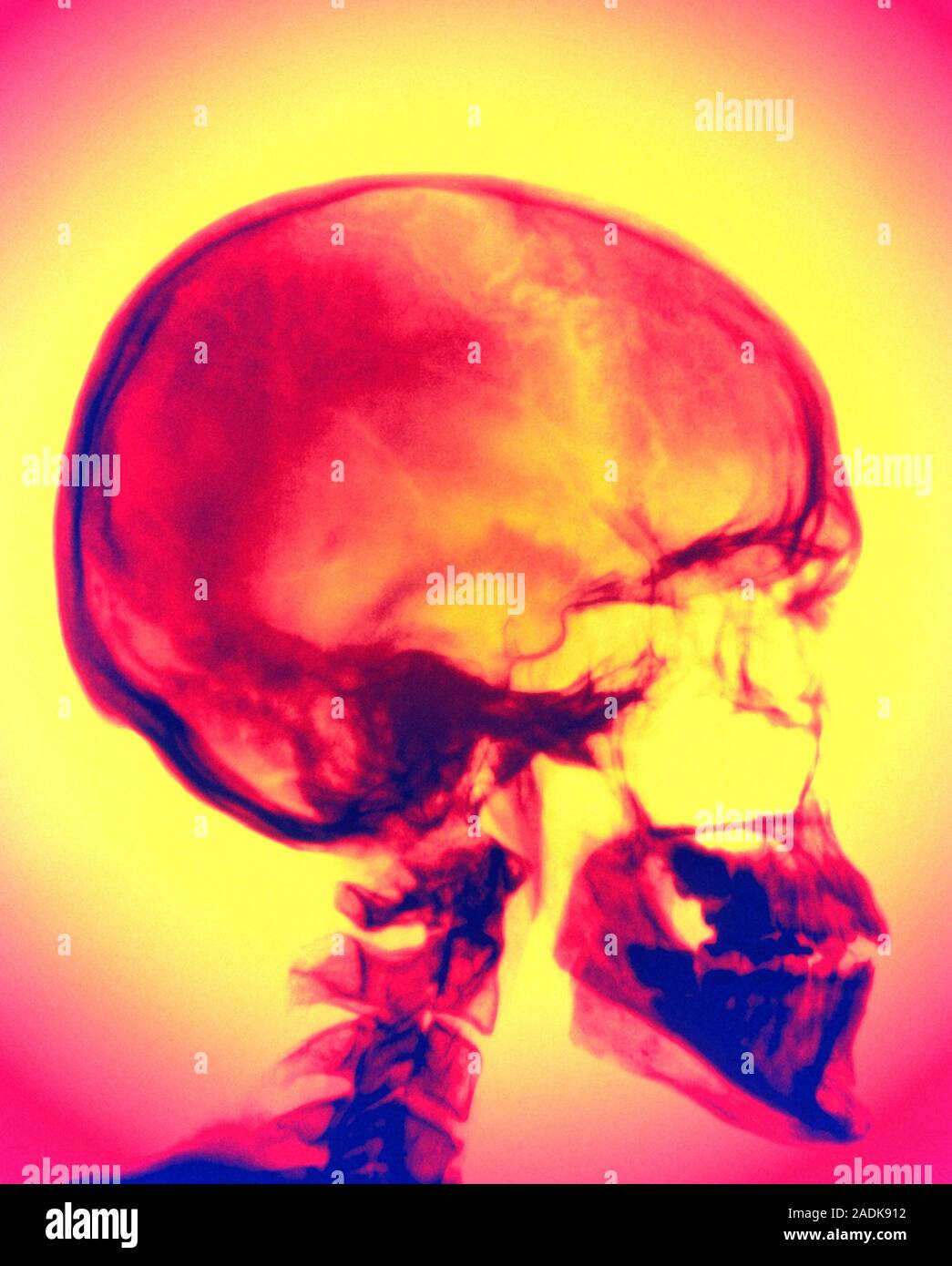 Human skull. Coloured X-ray of a side view of a human male skull. The ...